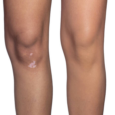 Quick-Fix® Body | Full Coverage Body Makeup – Dermablend Professional